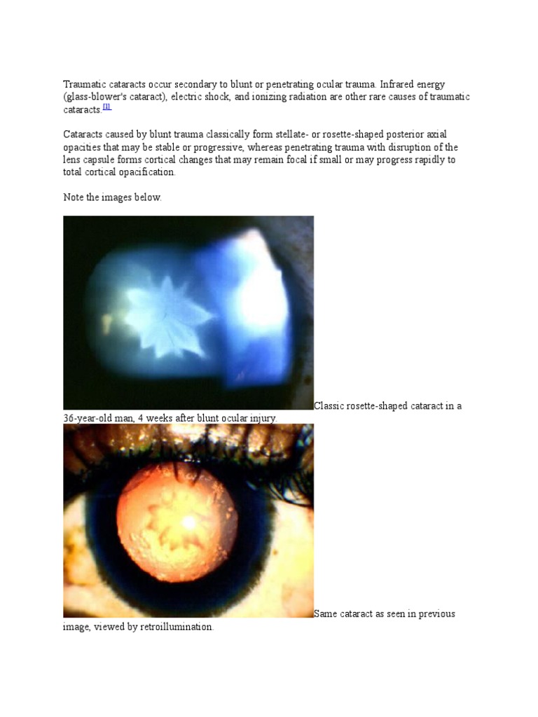 Traumatic Cataracts Occur Secondary To Blunt or Penetrating Ocular ...