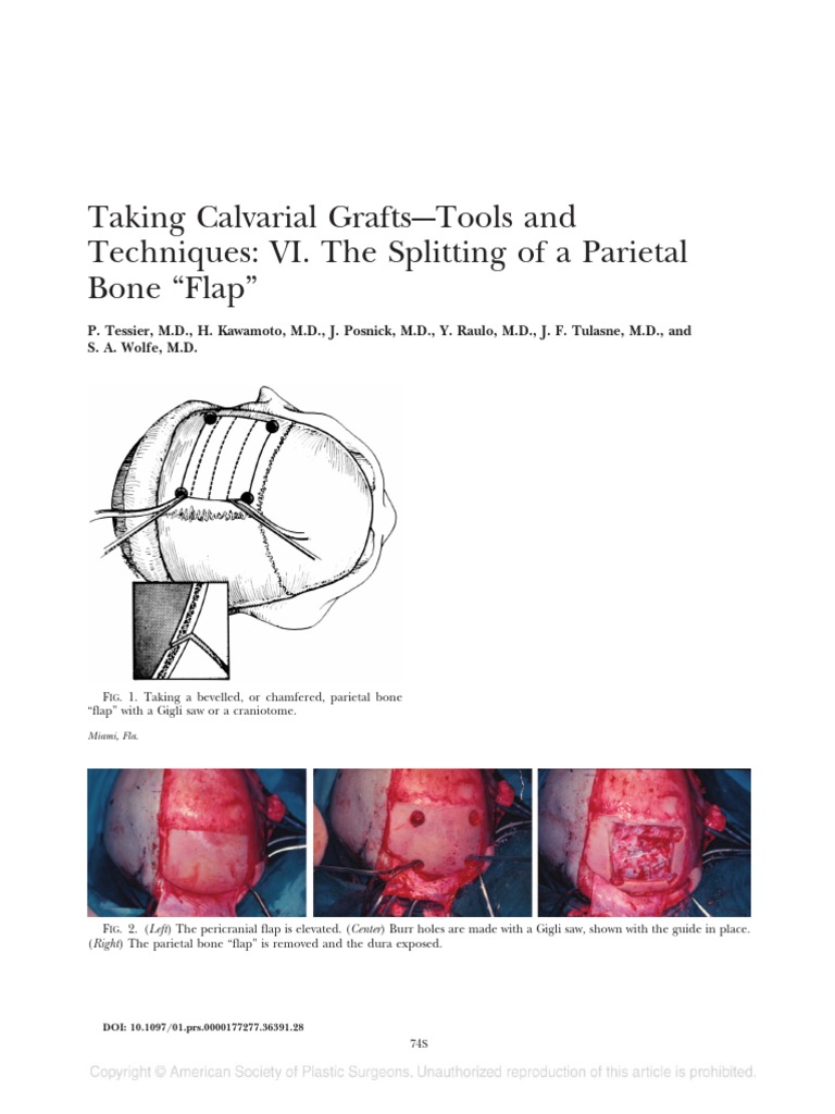 Taking Calvarial Grafts - Tools and Techniques - VI. The Splitting of A ...