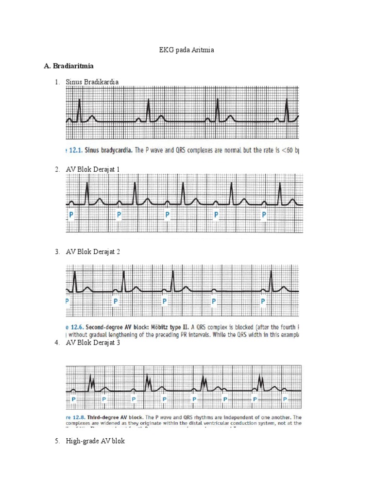 EKG Pada Aritmia | PDF