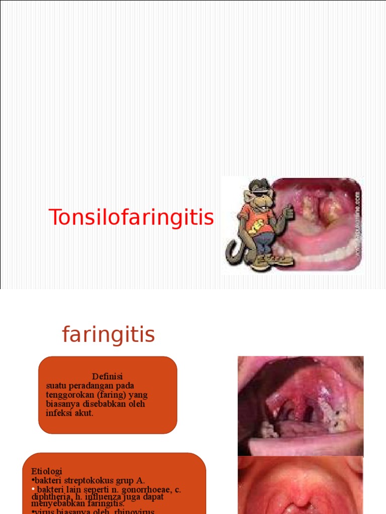 Tonsilofaringitis | PDF