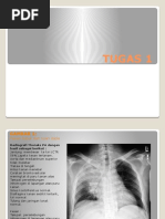 Anatomi Thorax Normal + Gambaran Radiologi | PDF