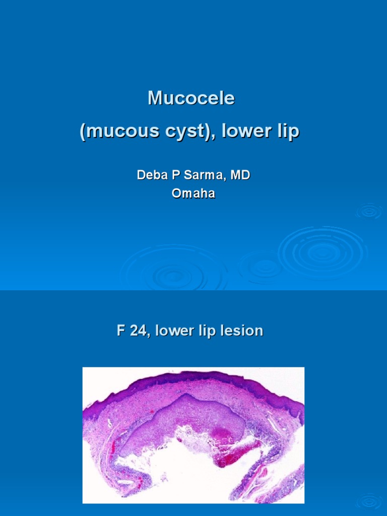 Mucocele | PDF