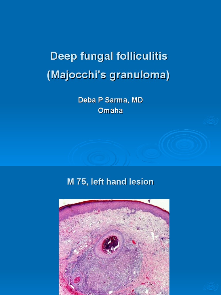 Deep Fungal Folliculitis (Majocchi's Granuloma) ., M 75, Left Hand. | PDF