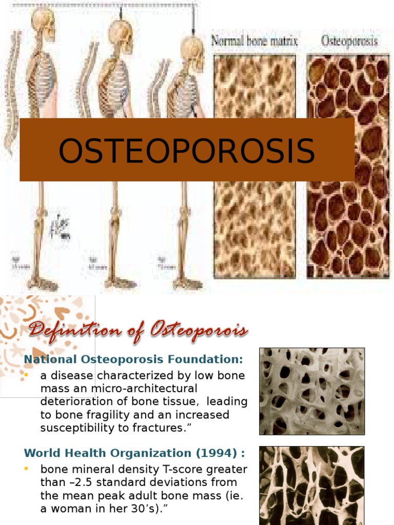 Osteoporosis Ppt Bone Osteoblast