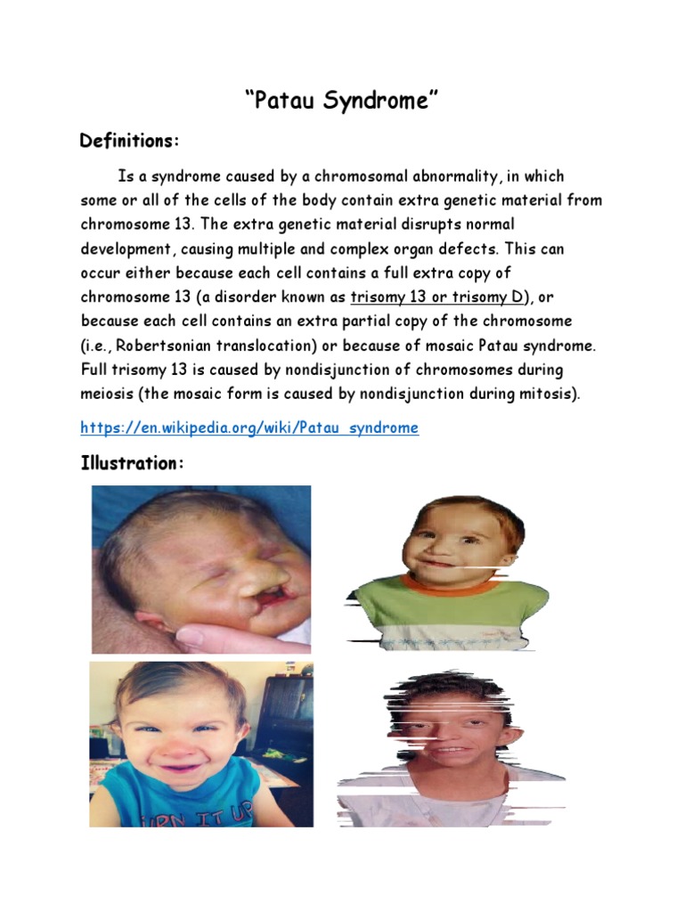 Patau Syndrome1 | PDF | Clinical Medicine | Biology