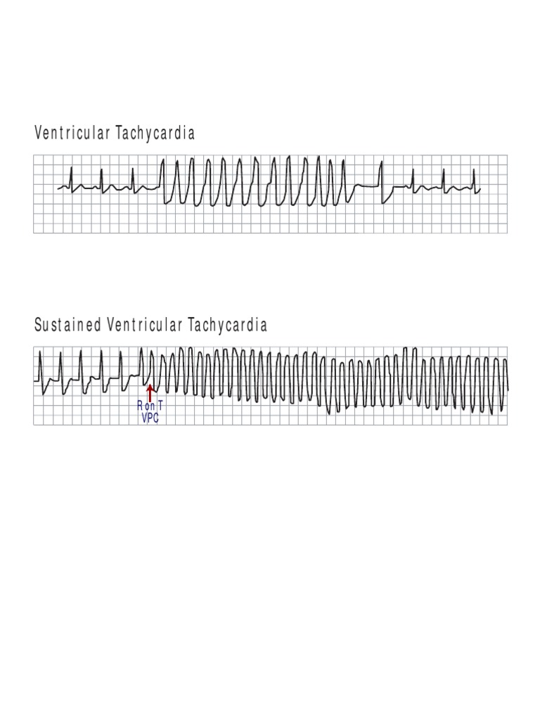 Vent Tac | PDF | Cardiovascular System | Cardiac Electrophysiology