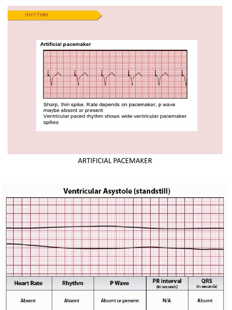 Ecg Strips | PDF
