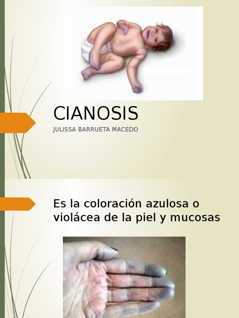 cianosis2