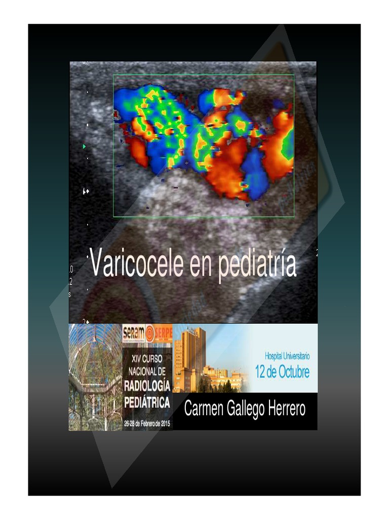 Varicocele en Pediatría: Diagnóstico y Tratamiento | PDF | Anatomia ...
