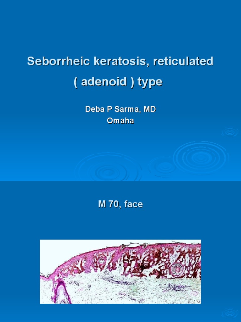 Seborrheic Keratosis Reticulated (Adenoid) Type., M 70, Face | PDF