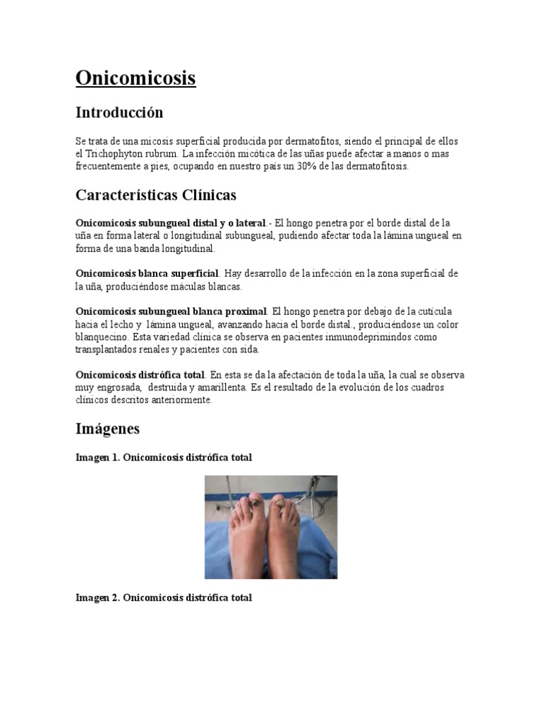 Onicomicosis: Tipos y Características | PDF | Condiciones cutáneas ...