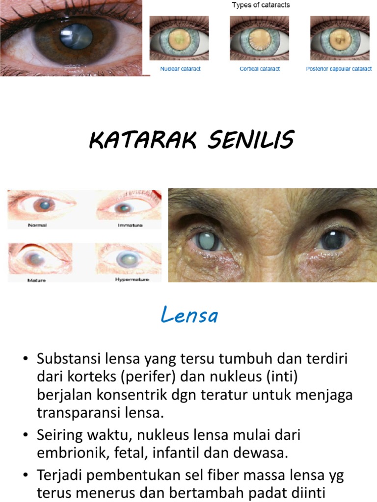 Katarak | PDF