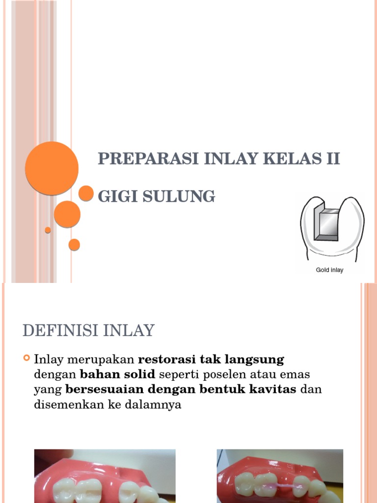 Preparasi Inlay Kelas II Gigi Sulung | PDF
