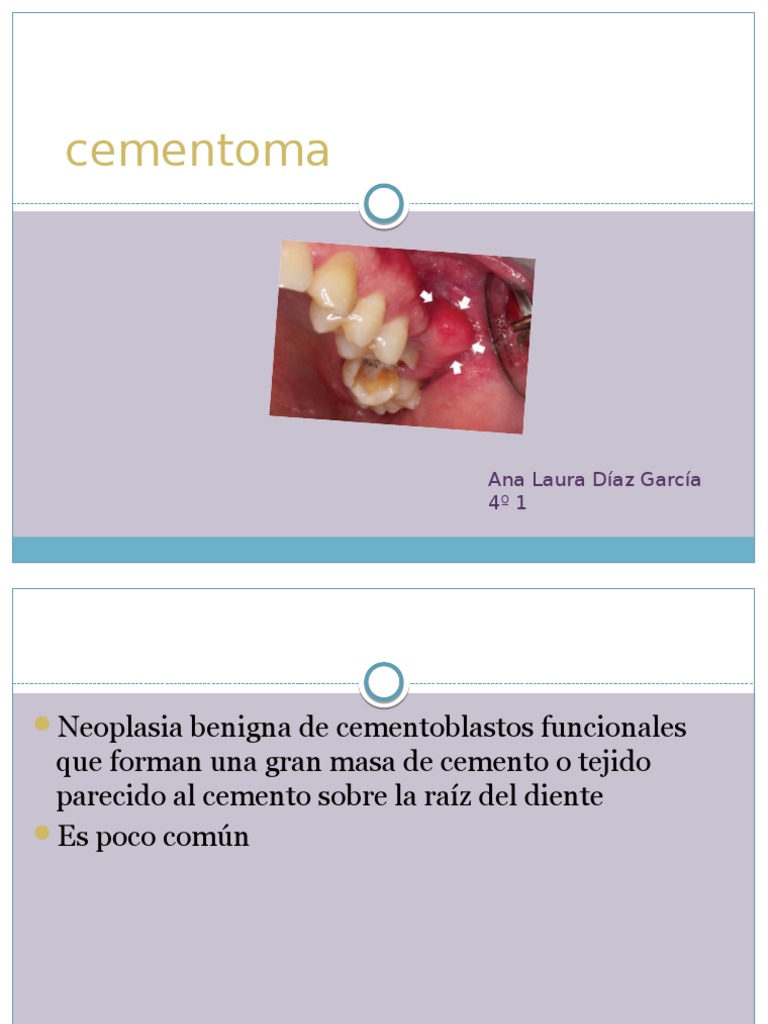Cementoma: Neoplasia Benigna Dental | PDF | Ciencia y matemáticas