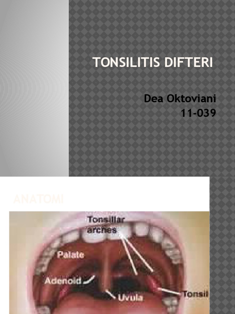 Tonsilitis Difteri | PDF