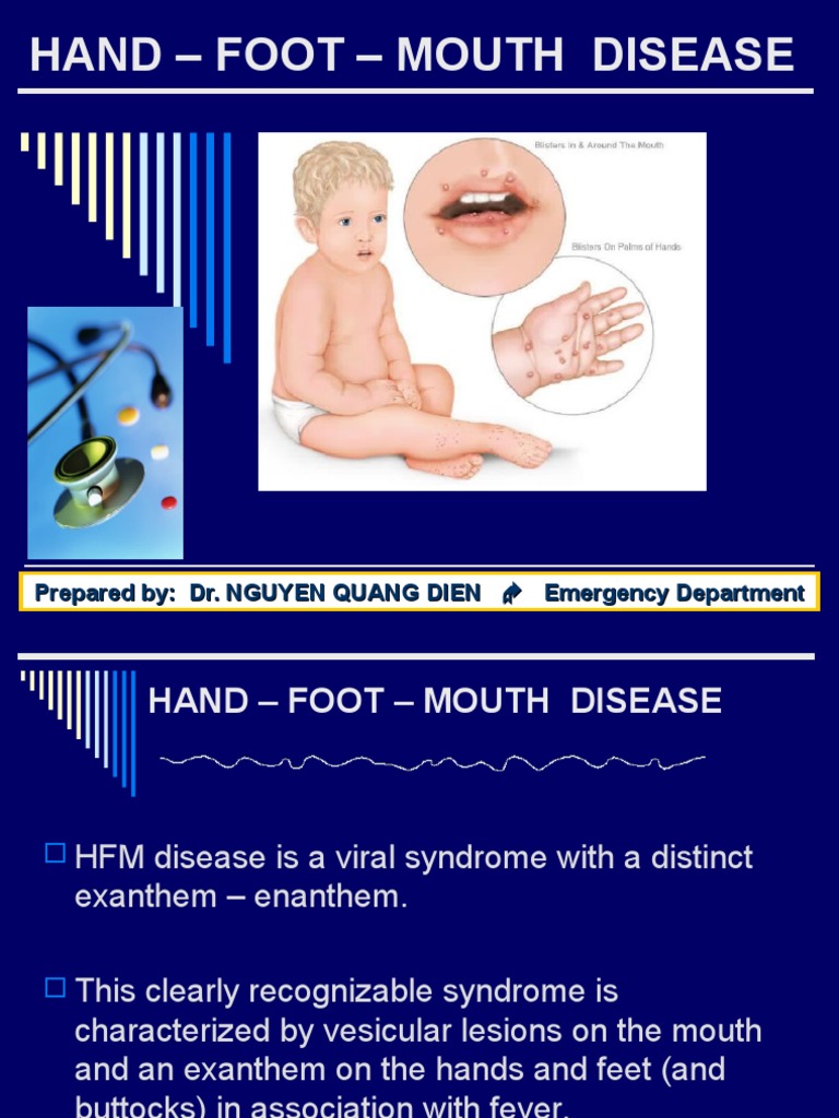 Hand - Foot - Mouth Disease: Prepared By: Dr. NGUYEN QUANG DIEN ...