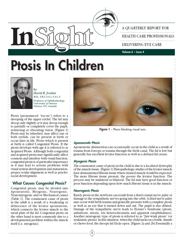 Ptosis | PDF