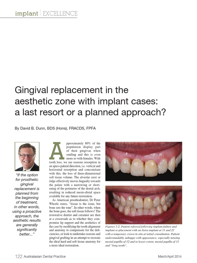 Gingival Replacement in The Aesthetic Zone | PDF | Dental Implant ...