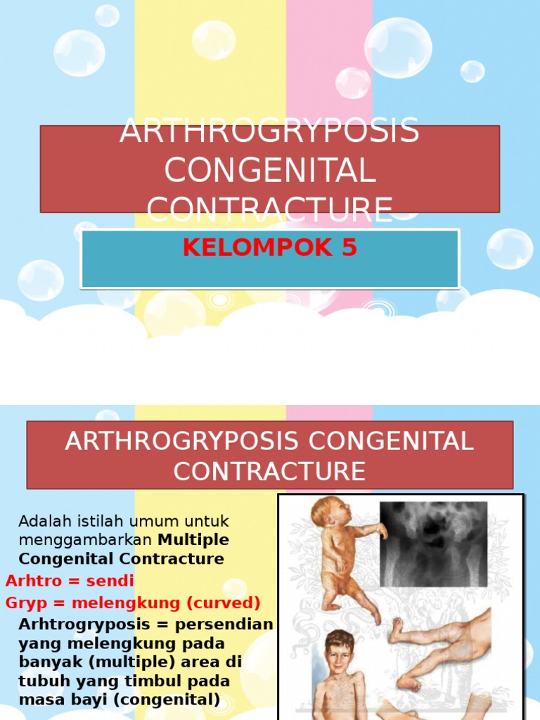 Arthrogryposis Congenital Contracture | PDF