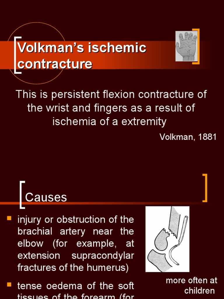 Volkman's Ischemic Contracture | PDF