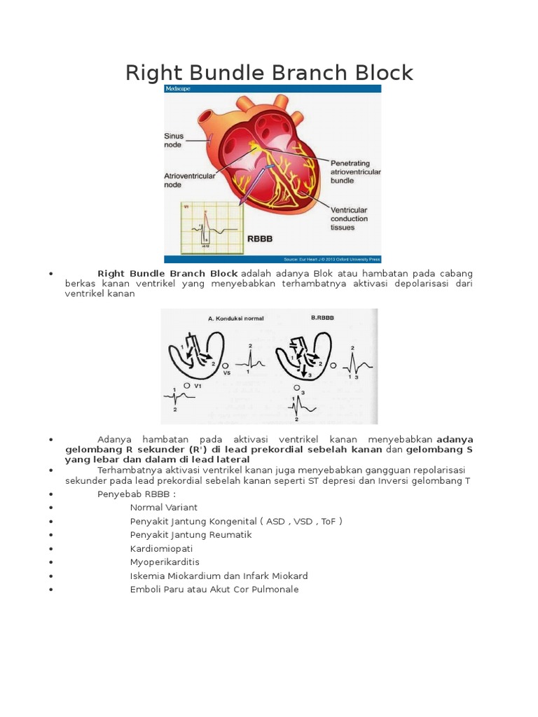 Right Bundle Branch Block | PDF