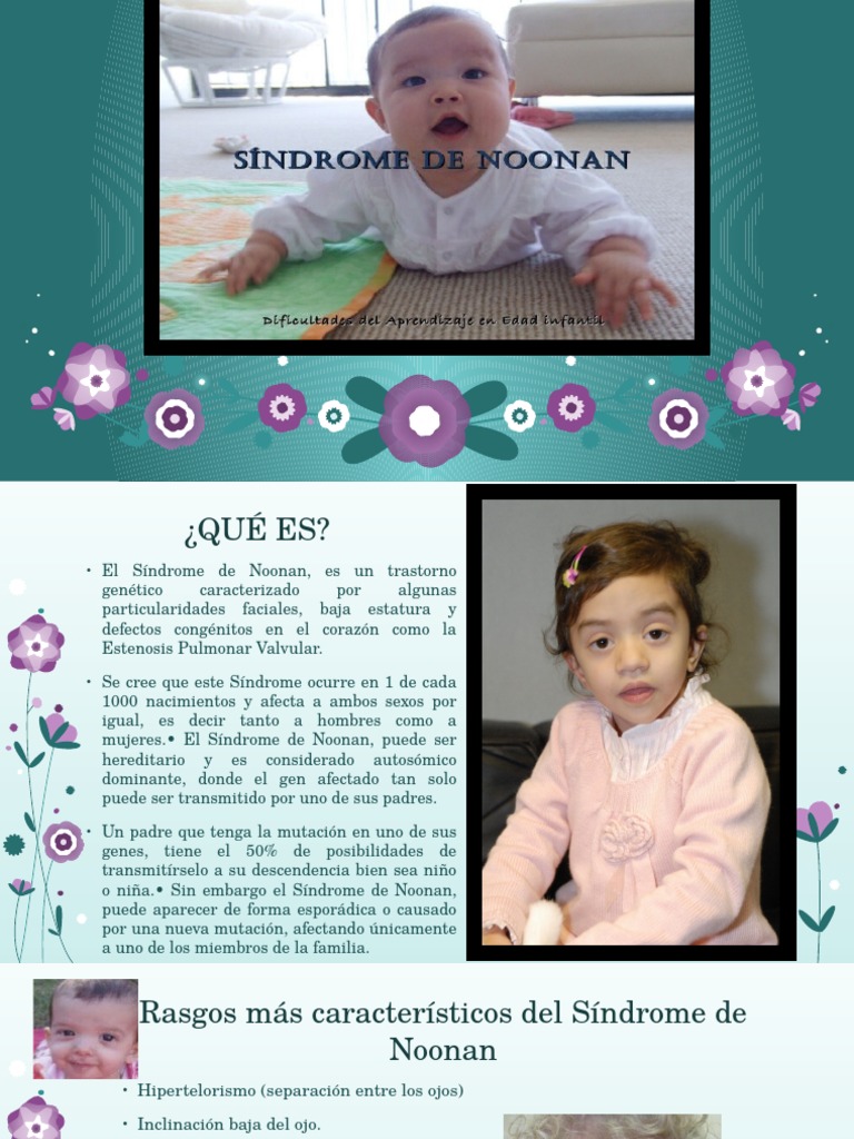 Sindrome de Noonan | PDF | Ojo humano | Mutación