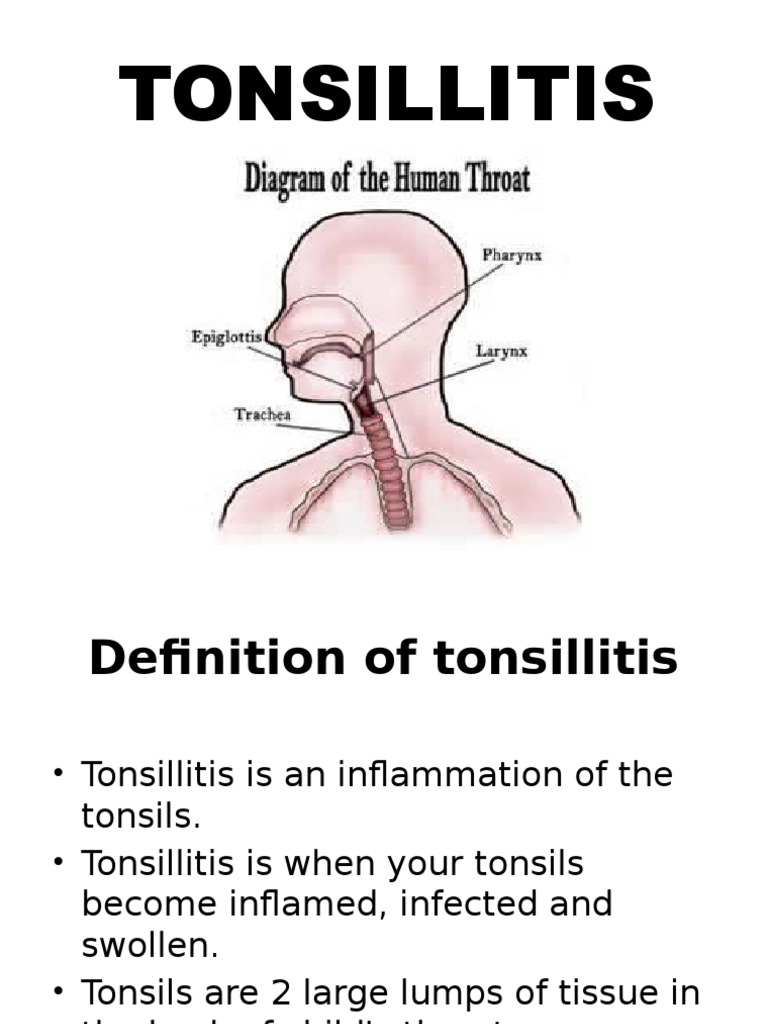A Comprehensive Guide to Tonsillitis: Causes, Symptoms, Diagnosis ...