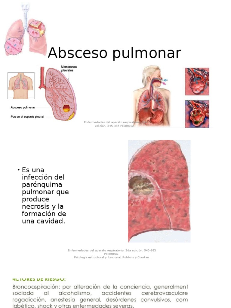Absceso pulmonar | Cough | Diseases And Disorders
