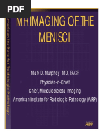 MRI Meniscus Tear Grading Guide | PDF