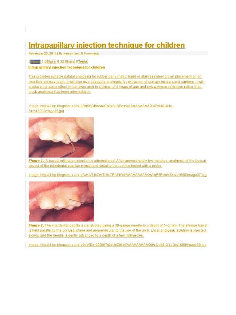 Intrapapillary Injection Technique for Children