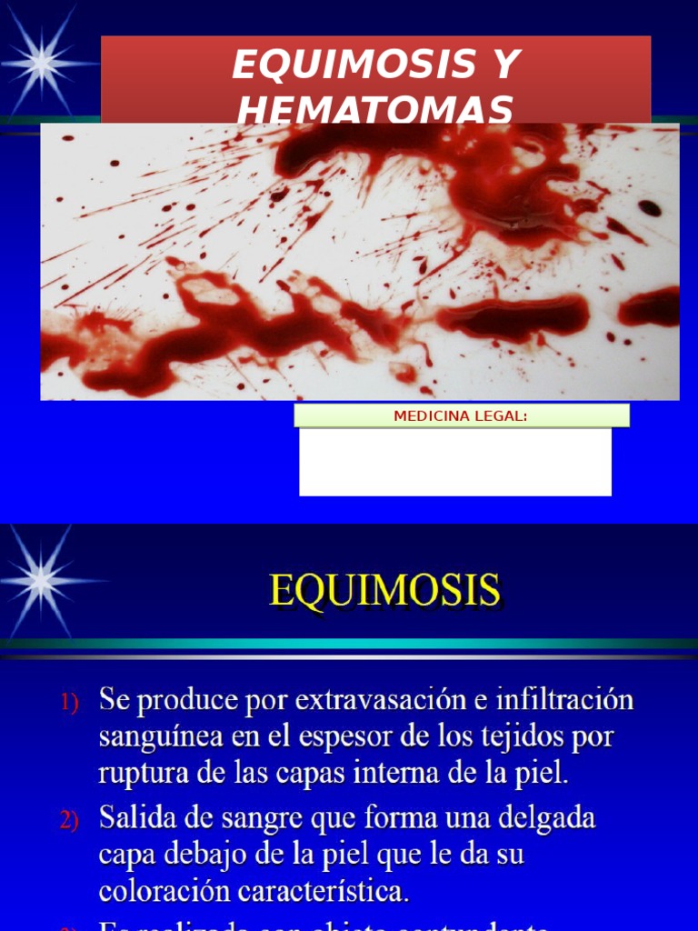 Equimosis