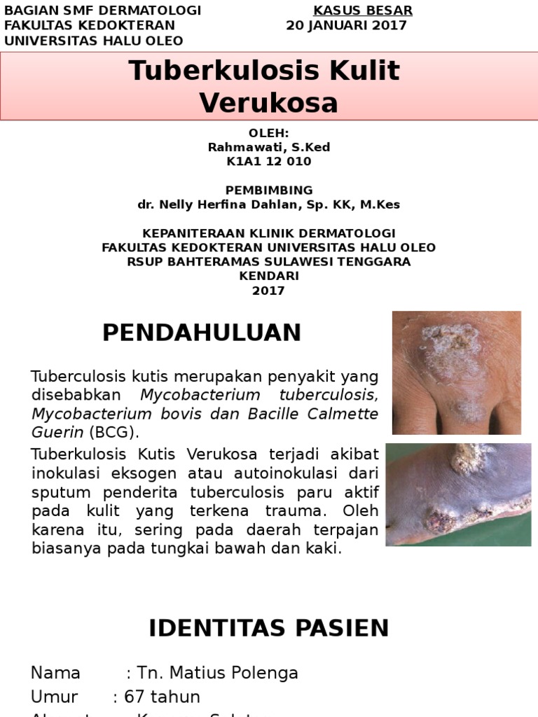 Tuberculosis Cutis Verukosa | PDF
