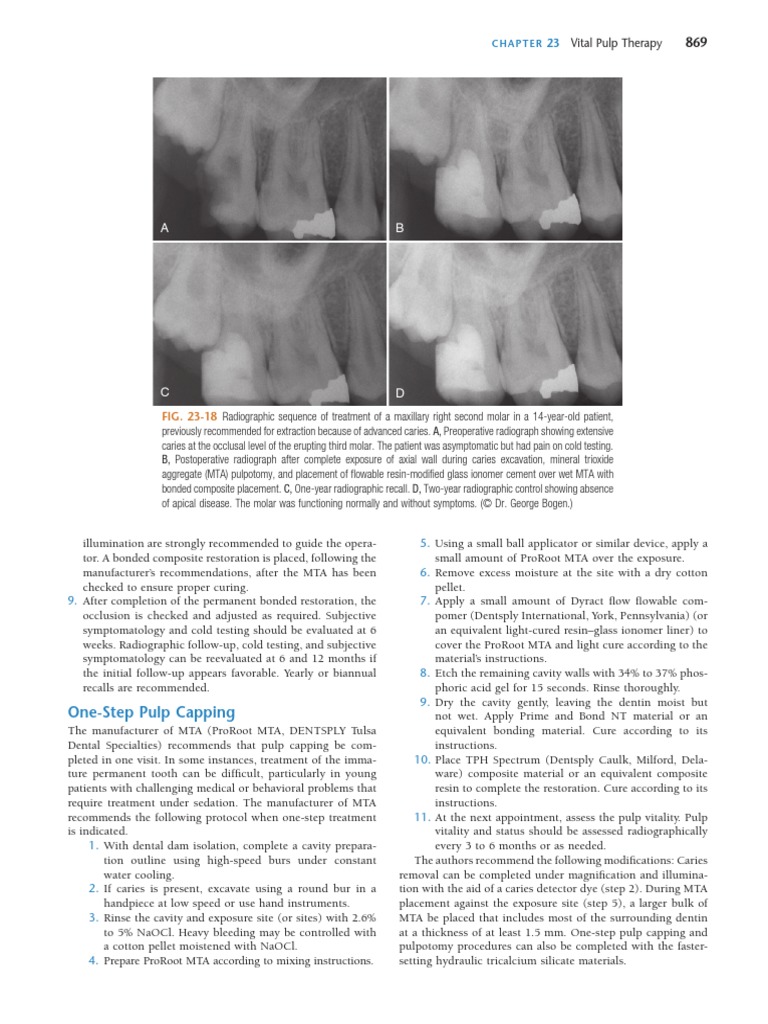 One-Step Pulp Capping | PDF | Dental Composite | Dentistry
