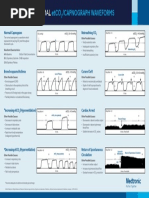 Capnograpy Ems Waveform Reference Card | PDF | Exhalation | Clinical ...
