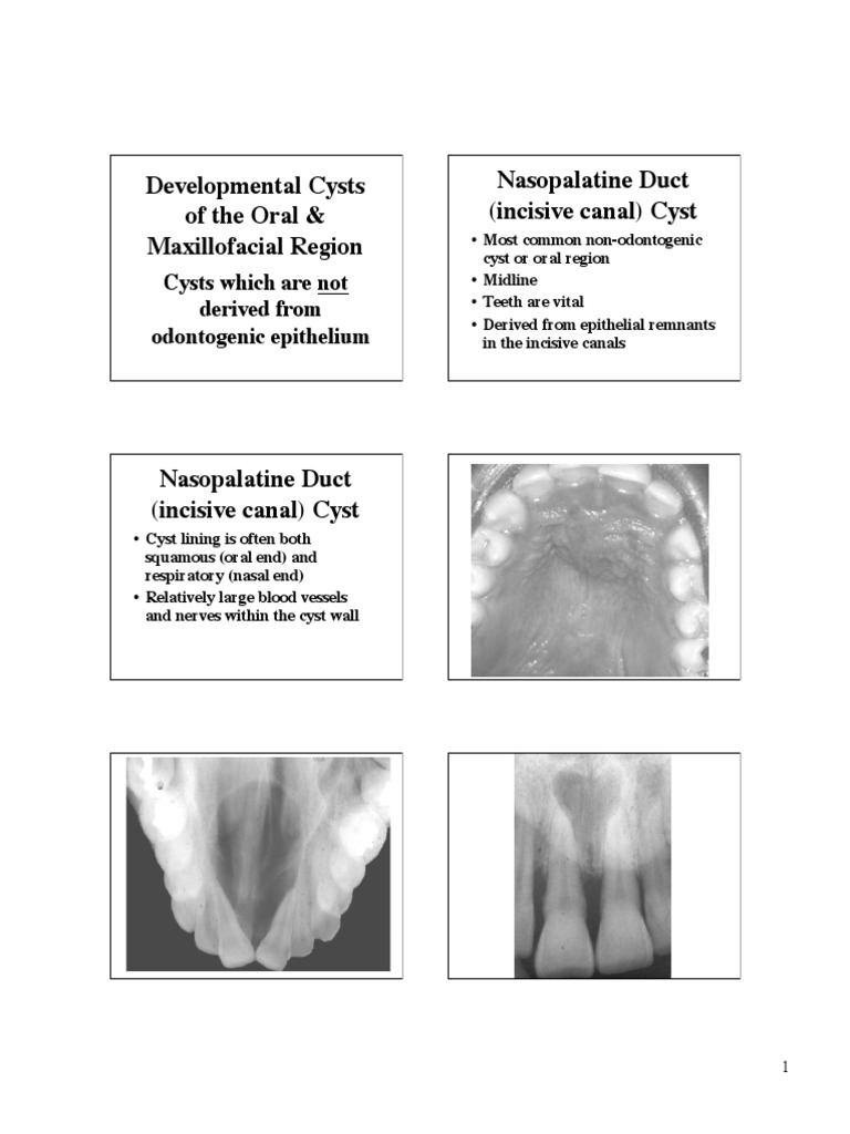 Developmental Cysts of The Oral & Maxillofacial Region Nasopalatine ...