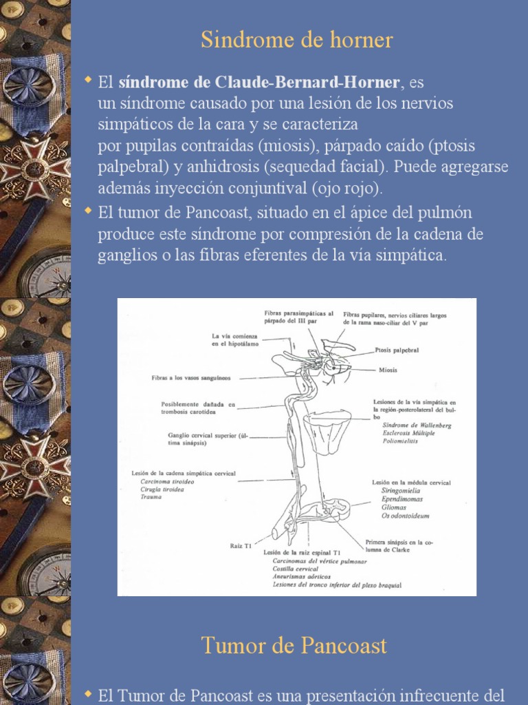 Sindrome de Horner | PDF