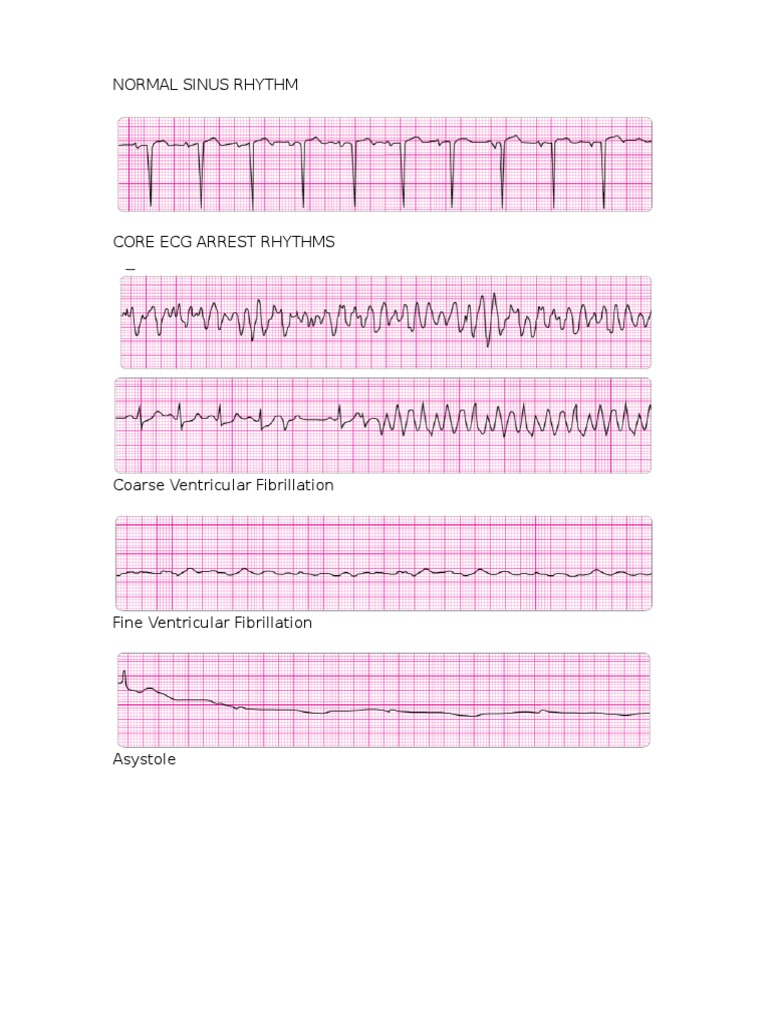 ACLS ECGs | PDF