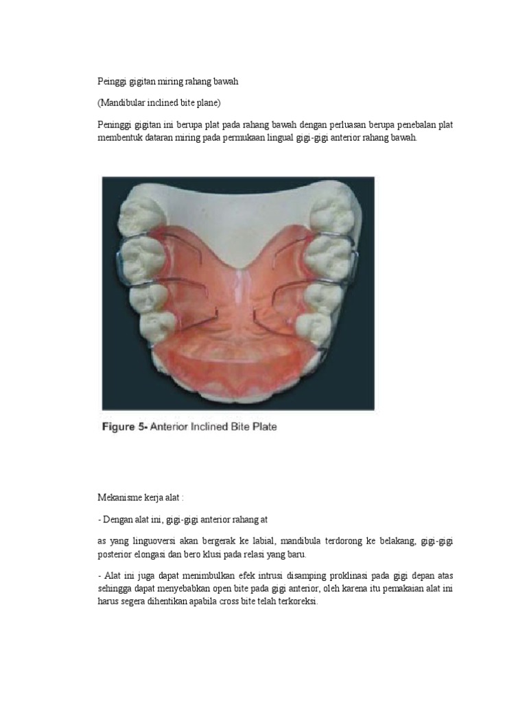 Mandibular Inclined Bite Plane | PDF