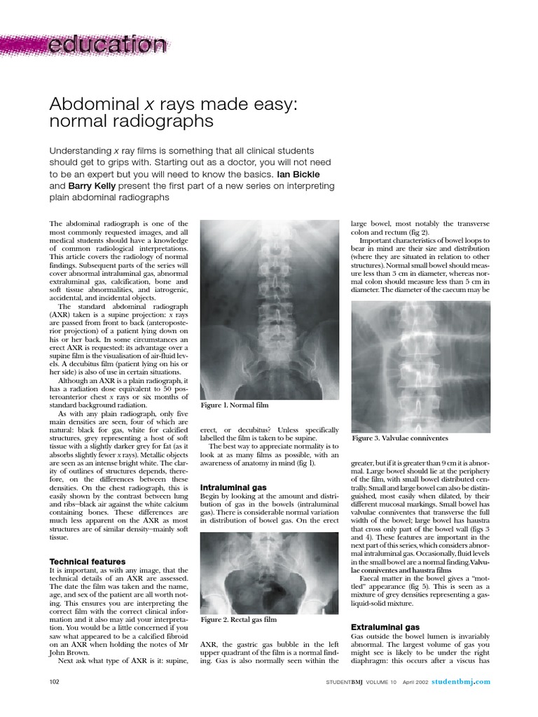Interpreting Normal Abdominal X-Rays | PDF | Kidney | Abdomen
