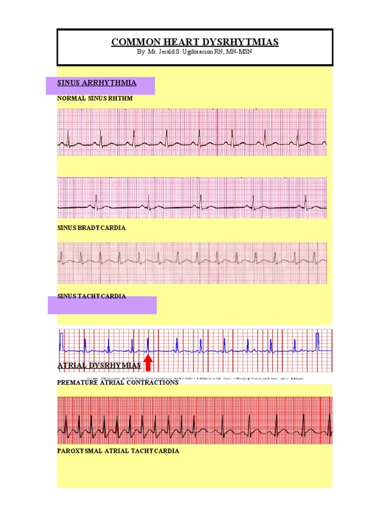 Cardiovascular SYSTEM - Heart Dysrythmia Illustrations | PDF