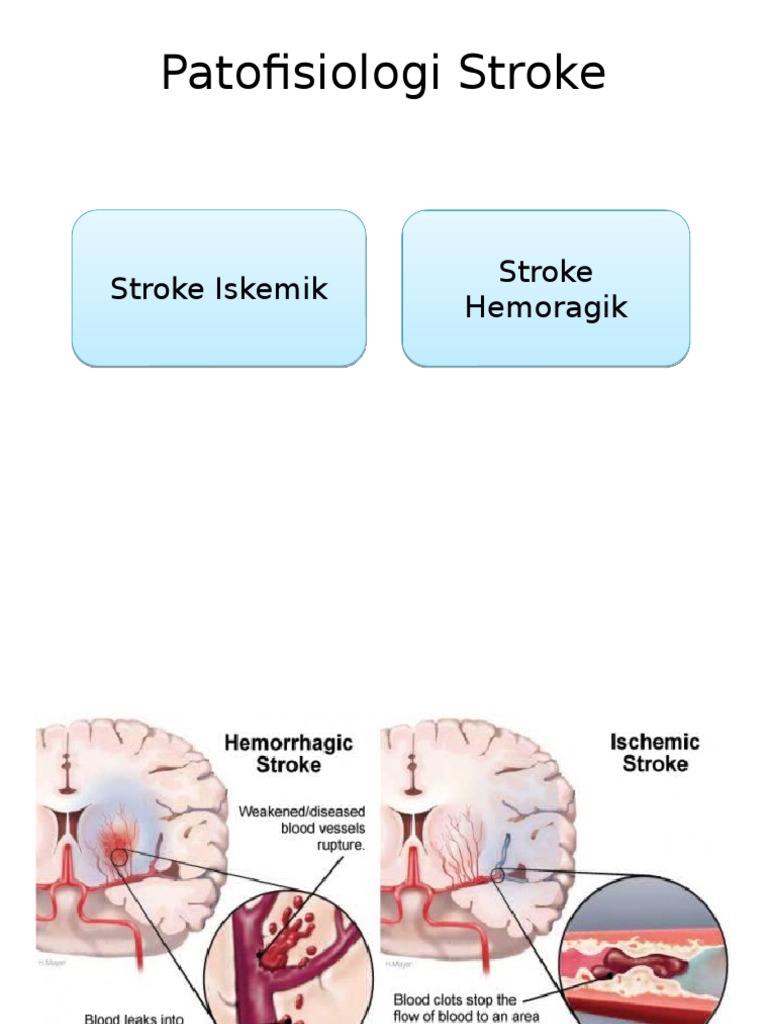Patofisiologi Stroke | Stroke | Microglia