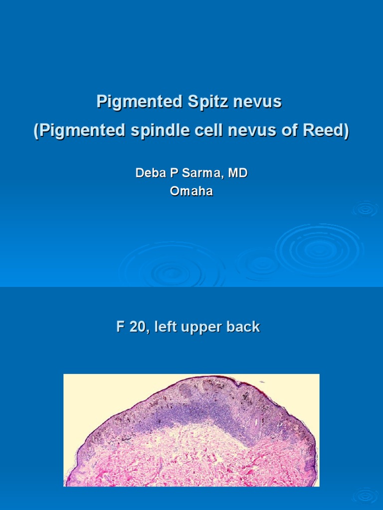 Pigmented Spitz Nevus (Pigmented Spindle Cell Nevus of Reed) | PDF