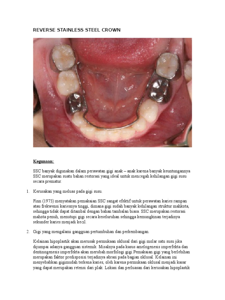 Reverse Stainless Steel Crown | PDF