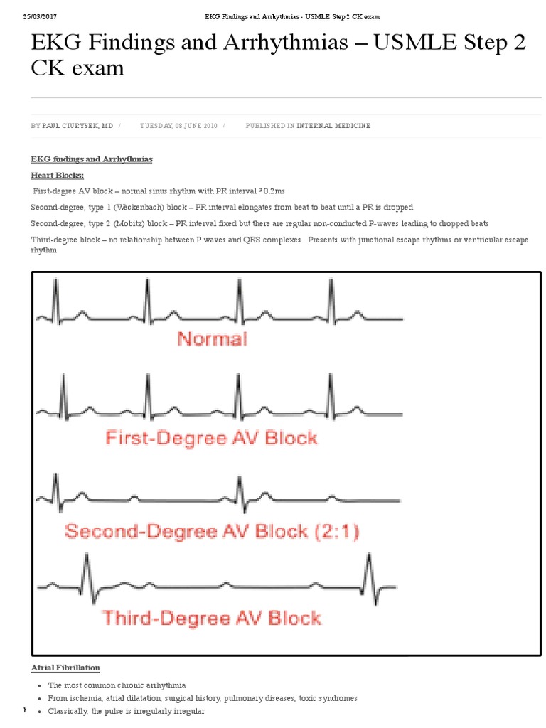 EKG Findings and Arrhythmias - USMLE Step 2 CK Exam | Cardiac ...