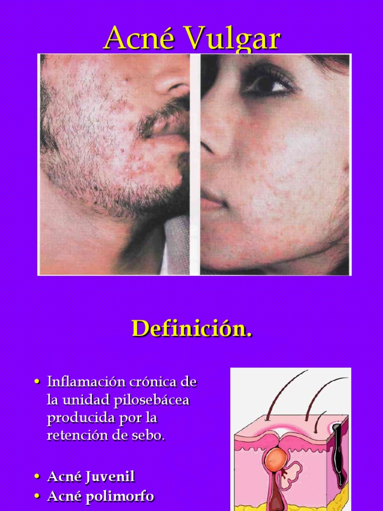 Acné Vulgar | PDF | Acné común | Dermatología