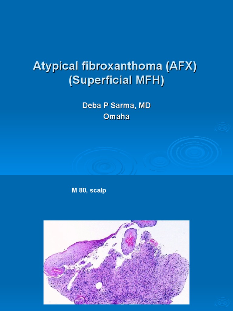 Atypical Fibroxanthoma (AFX), M 80, Scalp. | PDF