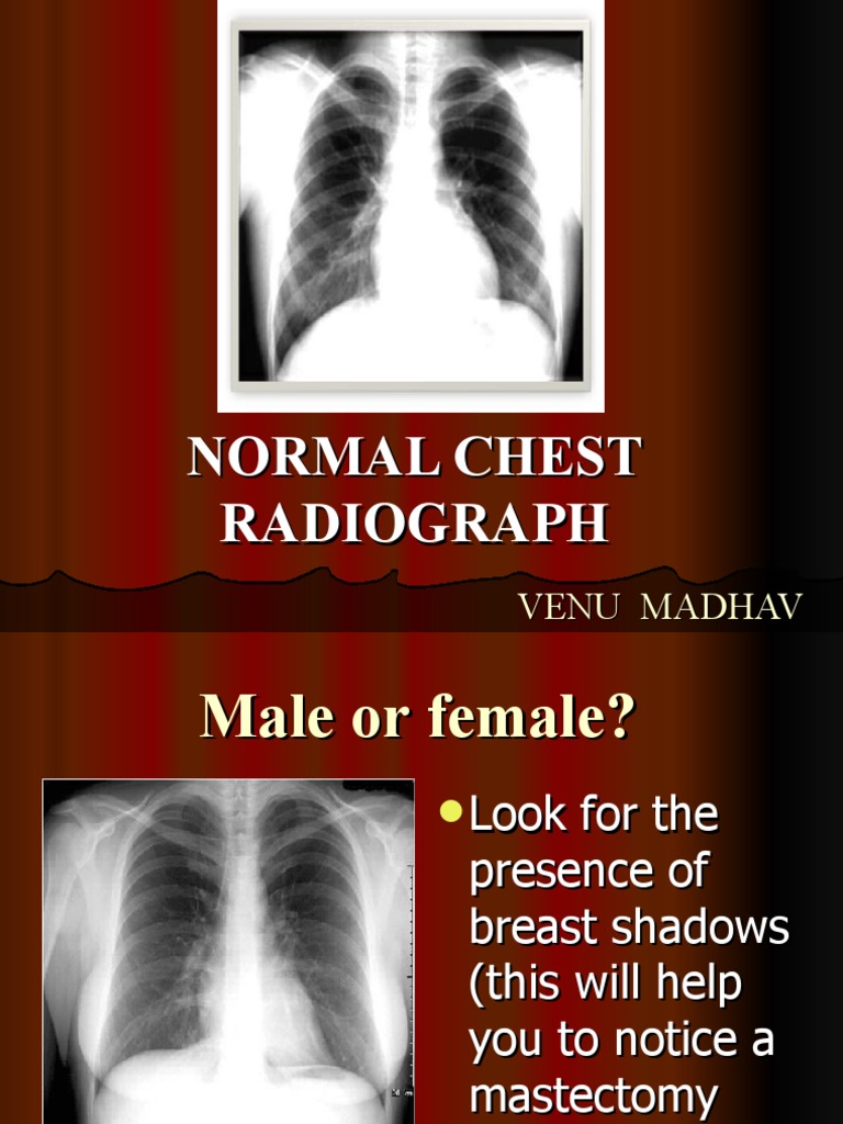 Normal Chest Radiograph | PDF