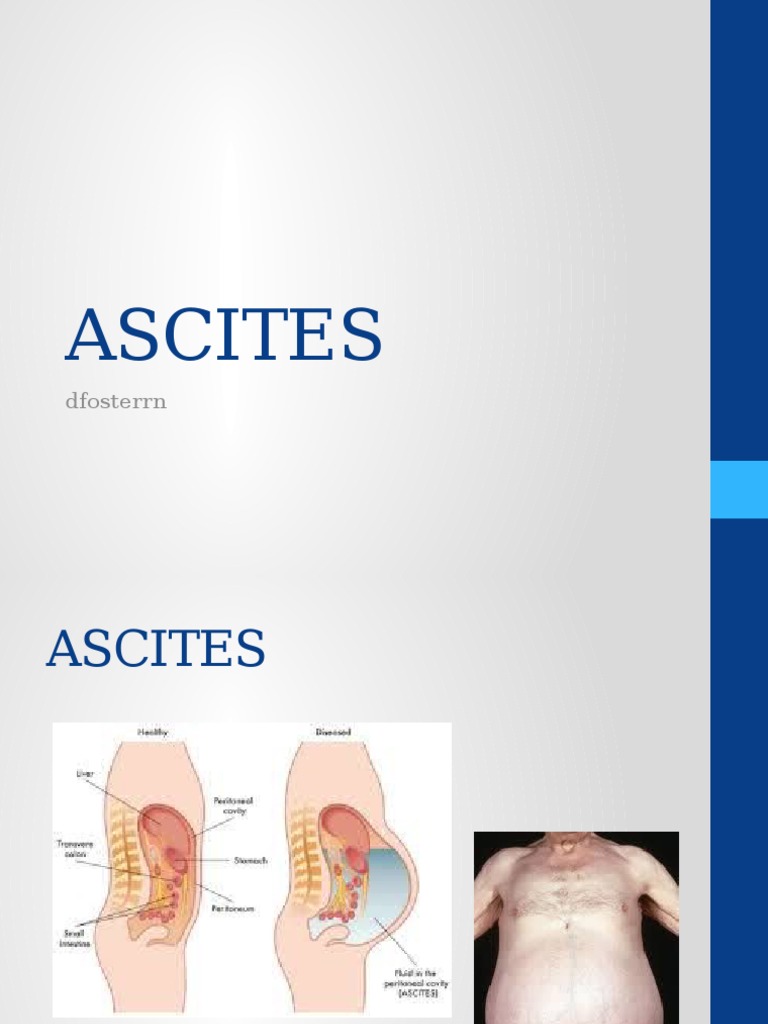 Ascites Presentation | Cirrhosis | Hepatitis