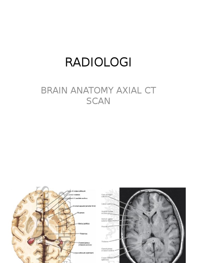 Radiologi: Brain Anatomy Axial CT Scan | PDF