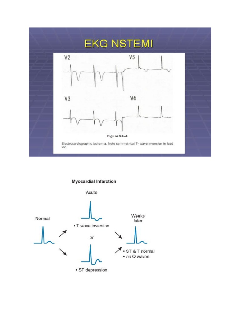 Gambar Ekg Nstemi | PDF